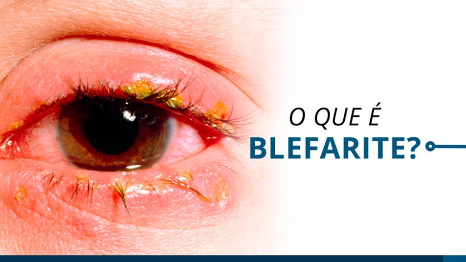 O que é Blefarite - Ocular Max Care - Dr. Fabrício Witzel